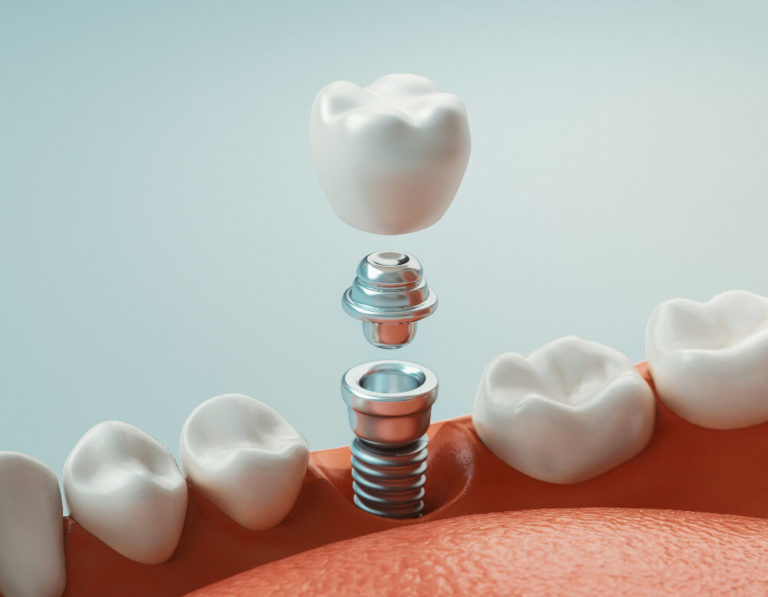 What's The Recovery Process After Dental Implants? | Brett Blacher, DDS